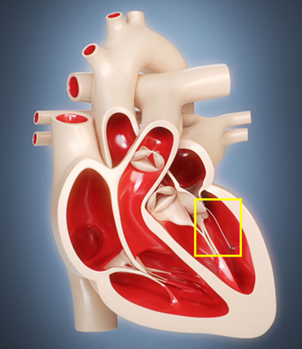 CardioMech Raises $13 Million for Transcatheter Mitral Chordal Repair ...